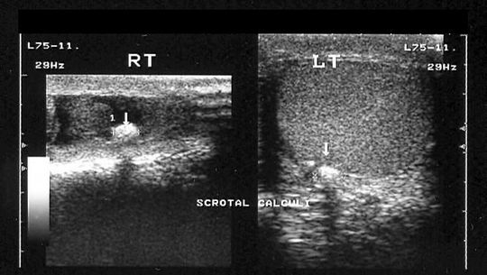 E-book: SCROTAL CALCULI-A SONOGRAPHIC ATLAS (PDF FORMAT) - Tradebit